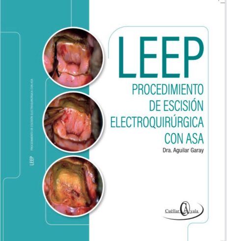 LEEP Procedimientos de escision electroquirurgica con asa | Cuellar Ayala